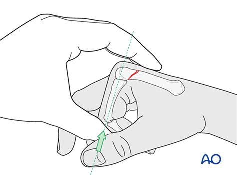 Closed Reduction Splinting For Extraarticular Fracture Of The Distal End Segment