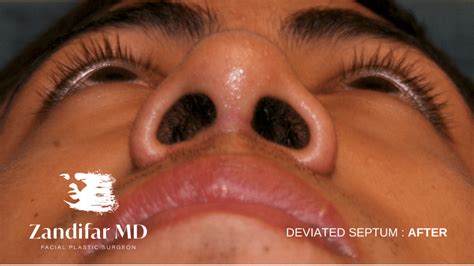 What Are The Signs You May Have A Deviated Septum Zandifar Md