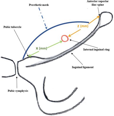 Schematic Drawing Of The Measurement Of The Distance Between The Pubic Download Scientific