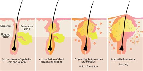 Sebaceous Glands Location Functions And Pictures
