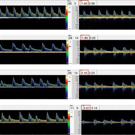 Left And Right Mca Tcd Waveforms During Dialysis In A Patient With