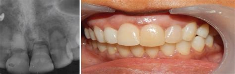 Nonsurgical Management Of Horizontal Root Fracture Associate Indian Journal Of Dental Sciences