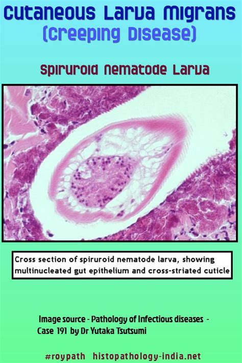 Cutaneous Larva Migrans Histology
