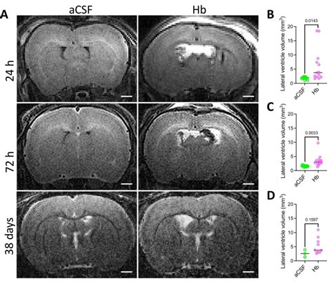 Injection Intraventriculaire