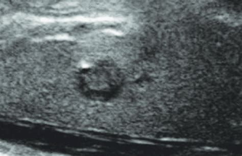 Thyroid Cancer Cells Under Microscope What Is Thyroid Cancer