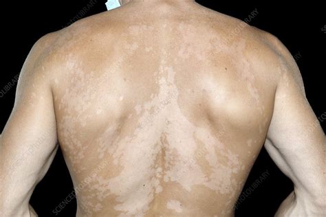 Pityriasis Versicolor Stock Image C0506762 Science Photo Library