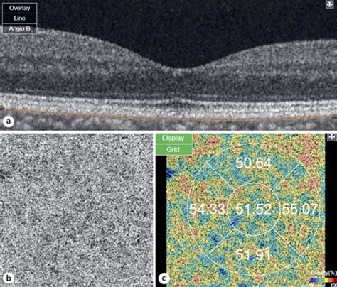 Macular Choroidal Thickness And Choriocapillaris Vessel Density Alterations In Type 2 Diabetics