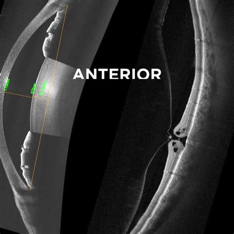 Visionix On Linkedin Eye Solix Oct Eyehealth