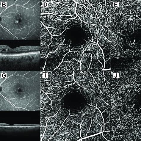 Multimodal Imaging And Optical Coherence Tomography Angiography Of Download Scientific Diagram