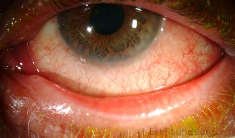 Follicular Conjunctivitis Causes