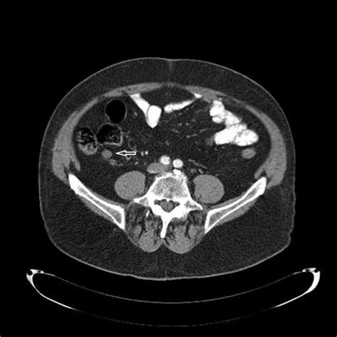 Surgical View Of The Appendix Mucocele Download Scientific Diagram