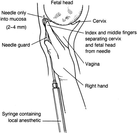 Paracervical Block During Labor