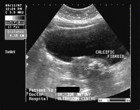 On Radiology Sonography Of Fibroid With Calcification