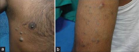 Disseminated Cutaneous Glomuvenous Malformation Indian Journal Of