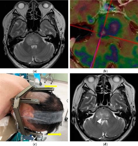 Figure 1 From The Role Of Stereotactic Frame Based Biopsy For Brainstem Tumors In The Era Of
