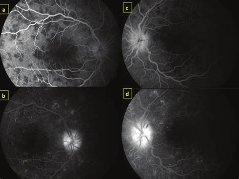 Fundus Fluorescein Angiography Of Both Eyes A C Show Early Hypo Download Scientific Diagram