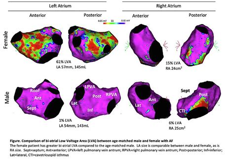 Sex Differences In Atrial Fibrillation And Atrial Structural Remodelling Insights From High