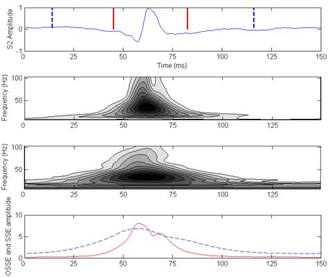 Phonocardiogram Signal Processing Module For Auto Diagnosis And Telemedicine Applications