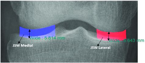 Automatic Measurements Of Joint Space Width Jsw Medial And Lateral Download Scientific