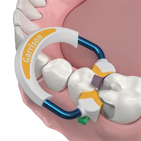 Strata G Tall Ring 2pk Optident Specialist Dental Products And Courses