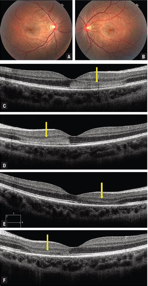Can You Recognize These Novel Oct Signs