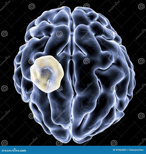 Aspergilloma Of The Brain Stock Illustration Illustration Of