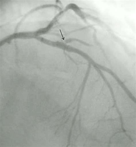 The Black Arrow Shows A Small Side Branch Vessel Occluded After Double Download Scientific