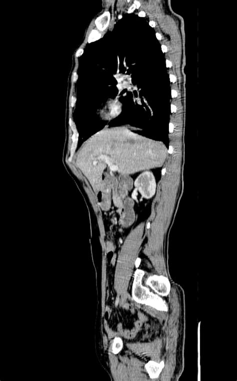 Nutcracker Syndrome Radiopaedia 62917 71302 C Nc Commons