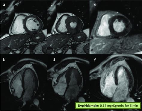 Stress Cmr A Stress Cmr Was Performed To Exclude Mi Showing Normal Download Scientific