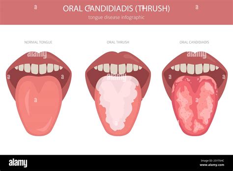 Oral Thrush Oral Candidiadis Disease Medical Infographic Design