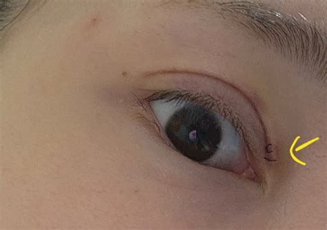 쌍수 일주일차 실밥 뽑은 후기 세미아웃 자연유착 윗트임 멍 붓기관리 부리부리 찜질 세안 1일차 ~7일차 경과 네이버 블로그