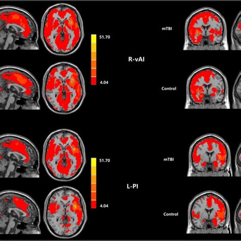 The Functional Connectivity Maps Of Four Insula Seed Rois L Vai