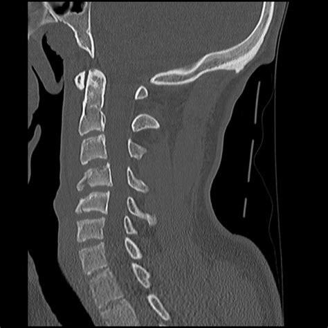 Cervical Flexion Teardrop Fracture With Cord Hemorrhage Radiology Case Radiopaedia Org Artofit