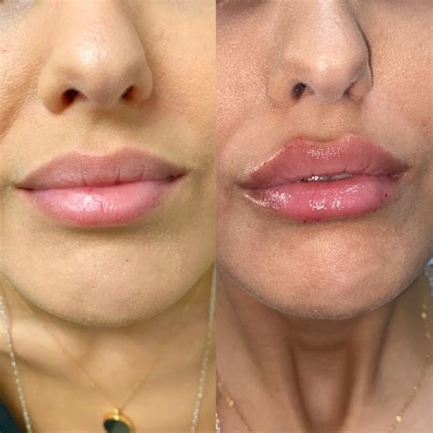 Before And After Photos Of A Woman S Lips