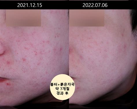 모공·흉터 천안피부과진료 천안스노우의원