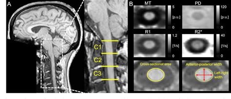Figure 1 From Reliability Of Multi Parameter Mapping Mpm In The Cervical Cord A Multi Center