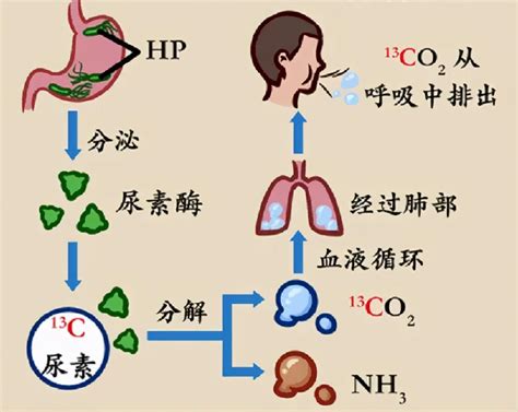 幽门螺杆菌检测方法大揭秘是呼气试验准还是胃镜准确 知乎