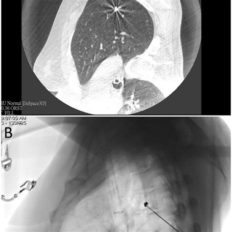 A An Intraprocedural Ct Scan Confirmed That Lg Was Properly
