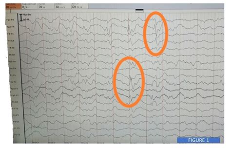 Triphasic Waves In Eeg An Atypical Finding In A Subacute Sclerosing Panencephalitis Sspe