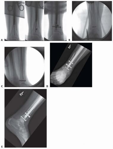 Intramedullary Nailing Of Metaphyseal Proximal And Distal Fractures Of The Mature Tibia