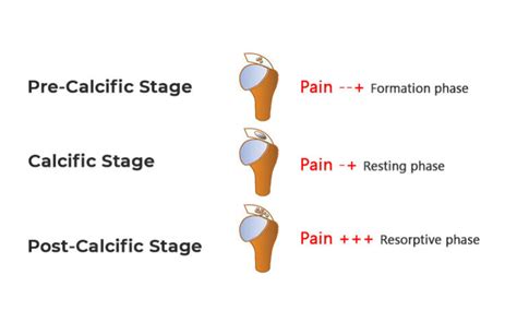 What Is Calcific Tendonitis A Comprehensive Overview Aspc Manipulation Therapy