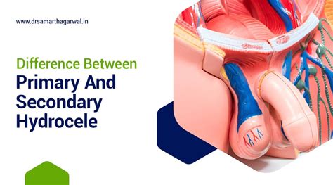 Difference Between Primary And Secondary Hydrocele Dr Samarth Agarwal