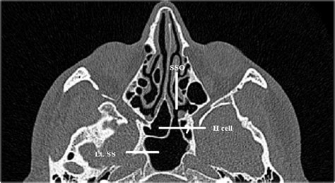 Axial Section Show The Left Sphenoid Sinus And H Cell Showing The