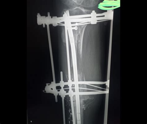Кости голени Портал радиологов