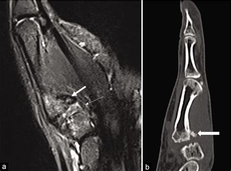 3t Magnetic Resonance Imaging Of The Thumb Normal Appearances And