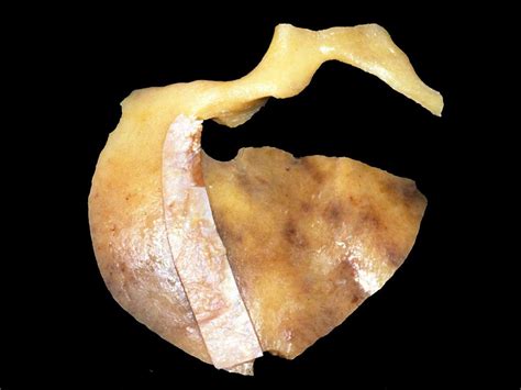 Bone Flap For Left Orbitozygomatic Osteotomy Neuroanatomy The Neurosurgical Atlas