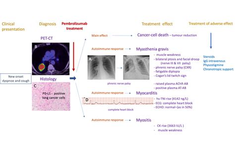 Myasthenia Gravis Myositis And Myocarditis A Fatal Triad