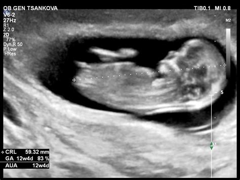 Фетална морфология Фетален ултразвук МЦ Свети Пантелеймон