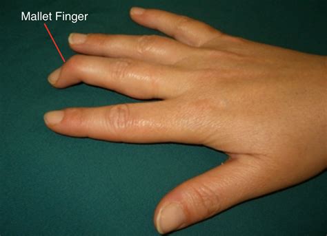 Mallet Finger