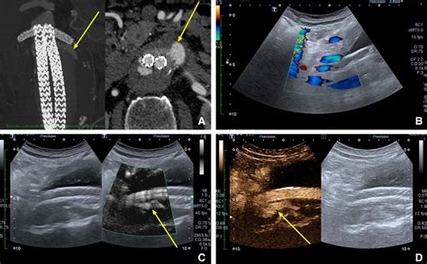 A Type I Endoleak Yellow Arrow According To Four Different Imaging